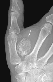 Myositis Ossificans and Fibrodysplasia Ossifica Progressiva | Medcrine ...